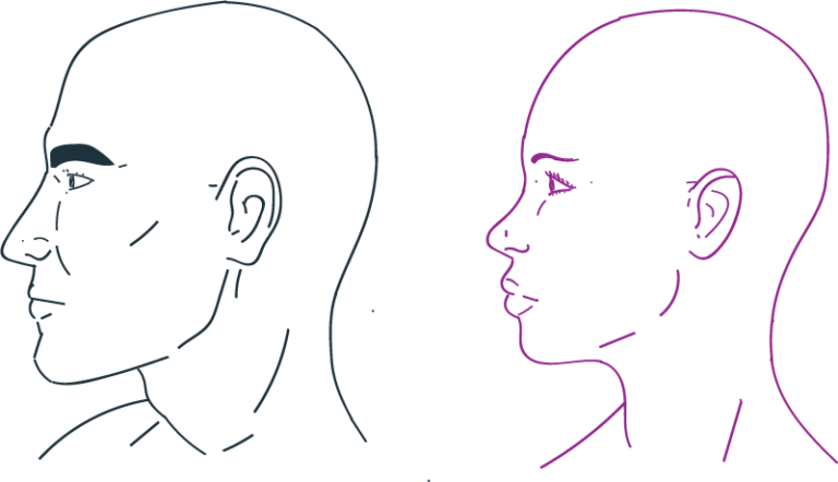 Brow bone reduction in facial feminisation surgery