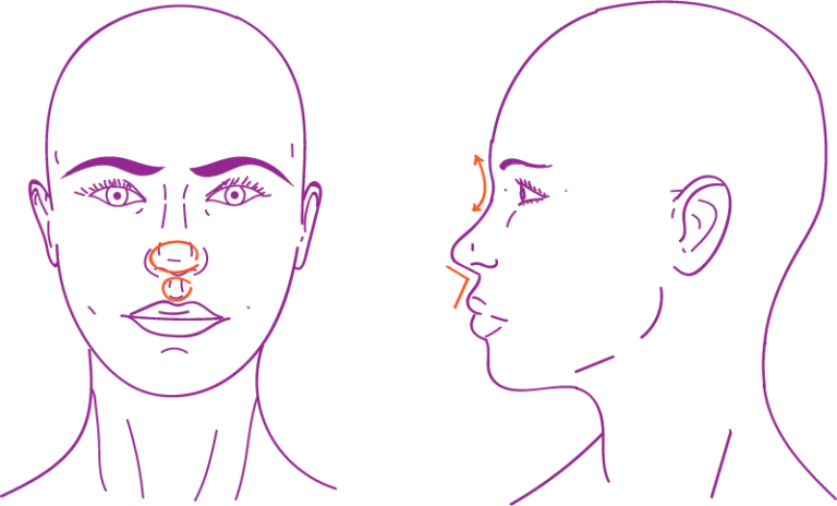 Nose feminization rhinoplasty - Facifem FFS Experts in Spain