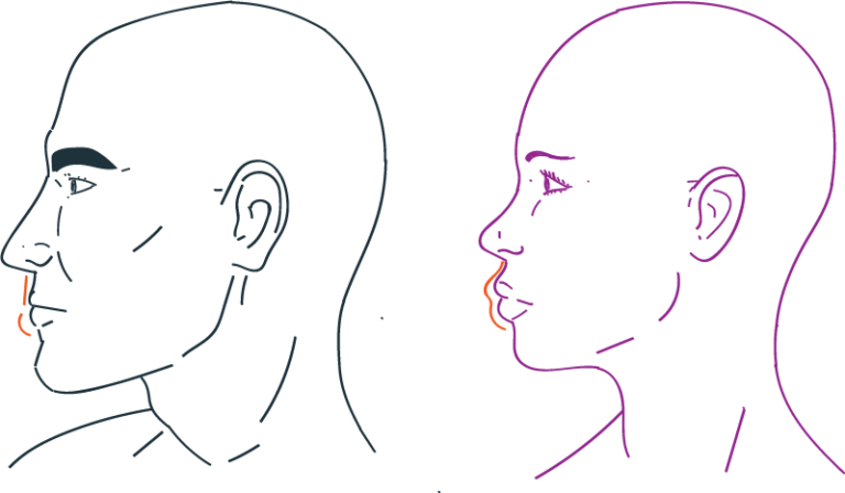 Lip lift in facial feminization surgery for transwomen - Surgeon Dr. Macía