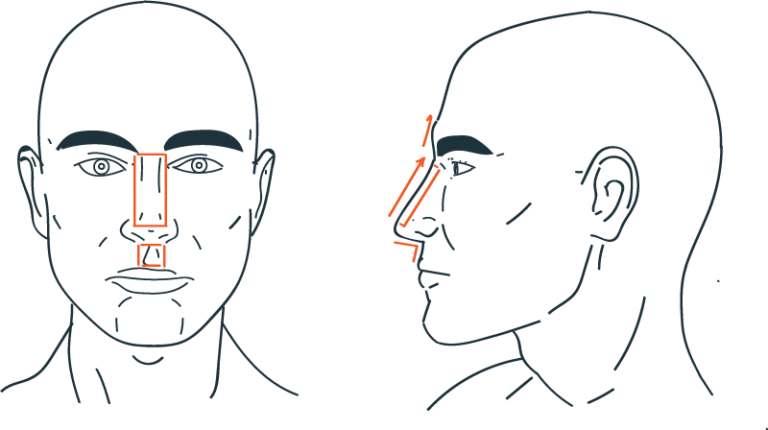 Nose feminization rhinoplasty - Facifem FFS Experts in Spain