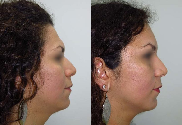 Brow bone reduction in facial feminisation surgery
